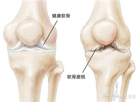 几年前受过伤，现在膝盖又疼了，怎么分辨两种关节炎 知乎