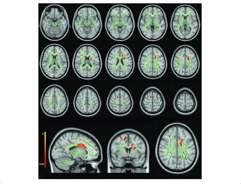 Axial Diffusivity Ad Map Showing Significantly Higher Ad Values In Download Scientific