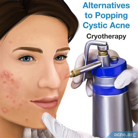 Nodular Acne Pop