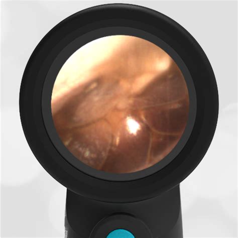 Chronic Otitis Media With Effusion Wiscmed