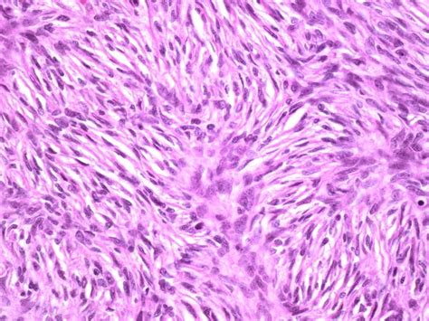 Dermatofibrosarcoma Protruberans Breast