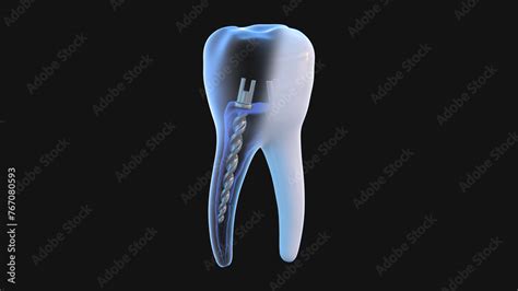 Dental Steel Post Inside Molar Teeth Xray View Dental Endodontic Treatment 3d Render