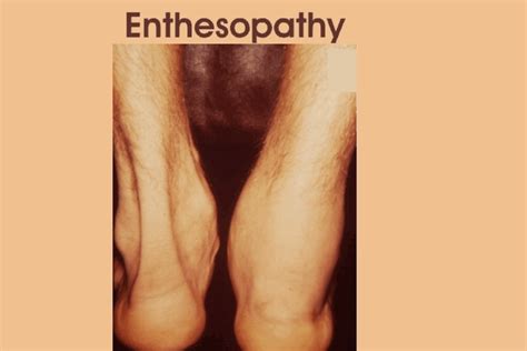 Spondyloarthropathy Clinical Manifestations Ankylosing Spondylitis