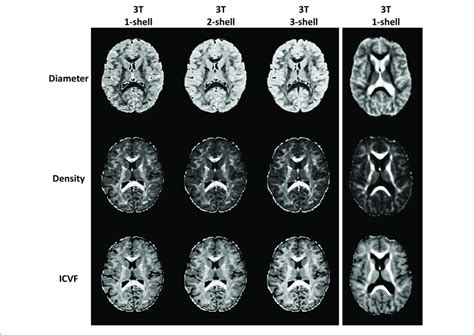 Outcome Comparison Between Single Shell And Multi Shell Acquisitions Download Scientific