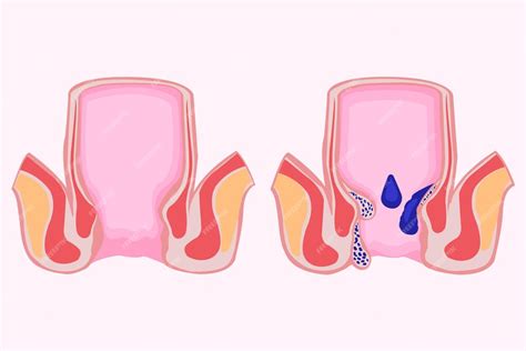 Premium Vector Illustration Of Hemorrhoid Normal And Abnormal Anus