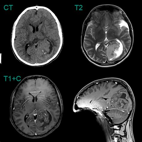 Ependymoma Neuroradiology