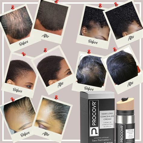 Procovr Hair Loss Concealer Cream With Dht Blockers Saw Palmetto