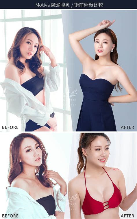 【motiva魔滴隆乳】全程hd內視鏡手術，隆乳術後擬真觸感極致加分 佳思優整形醫美診所