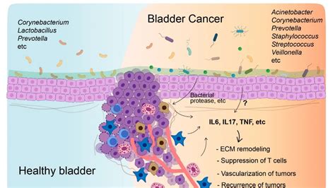 Urinary Microbiome Link To Bladder Cancer Risk A Potential New Biomarker