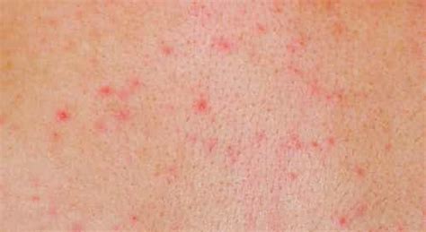 Red Spots On Breast Health Recovery Tips