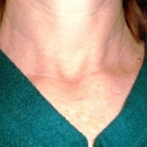 Thyroid Cancer What To Expect When Youve Been Diagnosed Healdove