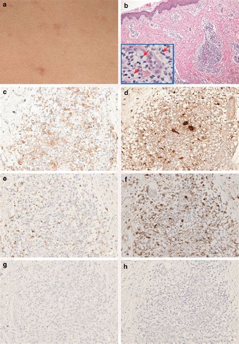 Clinical And Histological Findings Multiple Erythematous Plaques Of