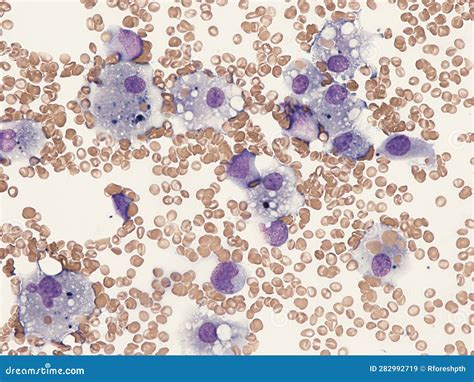 Proliferación De Macrófagos En Caso De Síndrome Hemofagocítico Imagen de archivo Imagen de