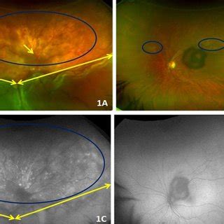 A Right Eye OCT Line Scan Passing Through The Temporal Aspect Of The Download Scientific