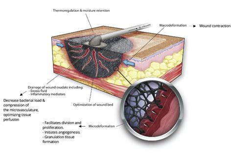 Pico Single Use Negative Pressure Wound Therapy System 42 Off