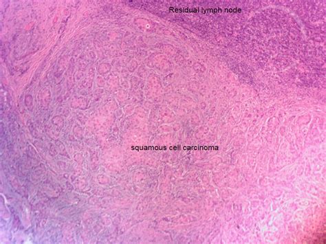Scalp Scc Metastasis To Neck Skin Cancer And Reconstructive Surgery