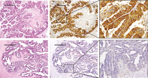 Immunohistochemical Analysis With Anti Cd44 Variant 6 Cd44v6 Antibody