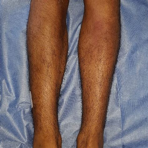 Erythematous Lesions Type Plaque In Lower Extremities Extensor Surface