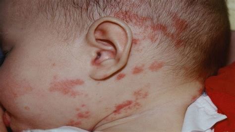 Bệnh Zona ở Trẻ Em Có Nguy Hiểm Không Các Biểu Hiện Của Bệnh