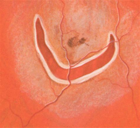 Peripheral Retina 5 Threats Flashcards Quizlet