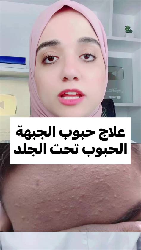 علاج حبوب الجبهة الحبوب تحت الجلد حبوبحبالشبابالحبوب Dr Menna