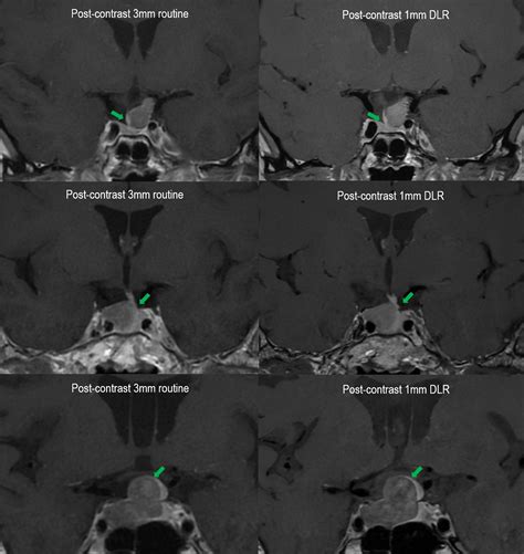 Deep Learning Based Image Reconstruction Improves Radiologic Evaluation