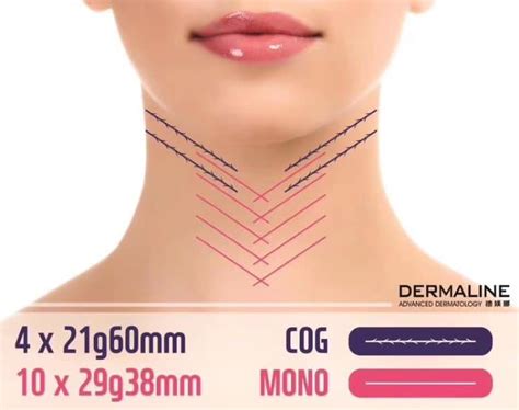 Pdopclplla Lifting Thread Tradekorea