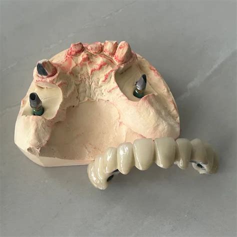 Dental Implants Customized Titanium Abutment Individually Adapted Patients Oral Anatomy Implant