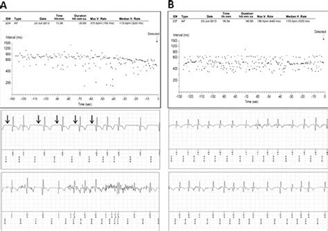 False And True Detection Of Af Episode By An Insertable Loop Recorder Download Scientific