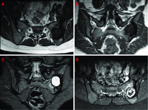 Mri Of The Sacrumpelvis With A Axial And B Coronal Precontrast T1
