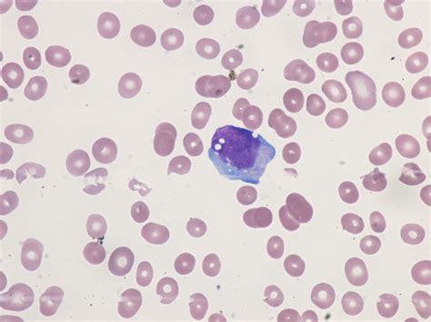 Acute Promyelocytic Leukemia Microgranular Variant
