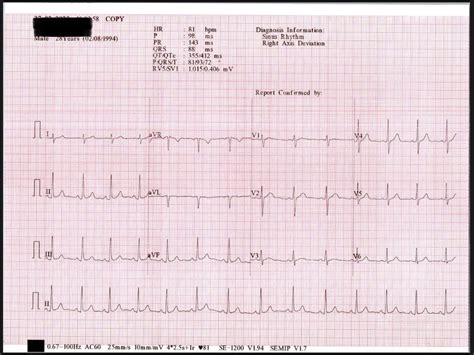 Should I Be Concerned About “right Axis Deviation” R Readmyecg