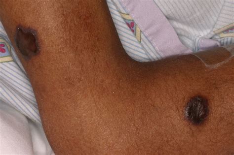 Kaposi Sarcoma School Of Medicine