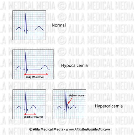 Alila Medical Media Ecg De Hipercalcemia E Hipocalcemia Ilustración