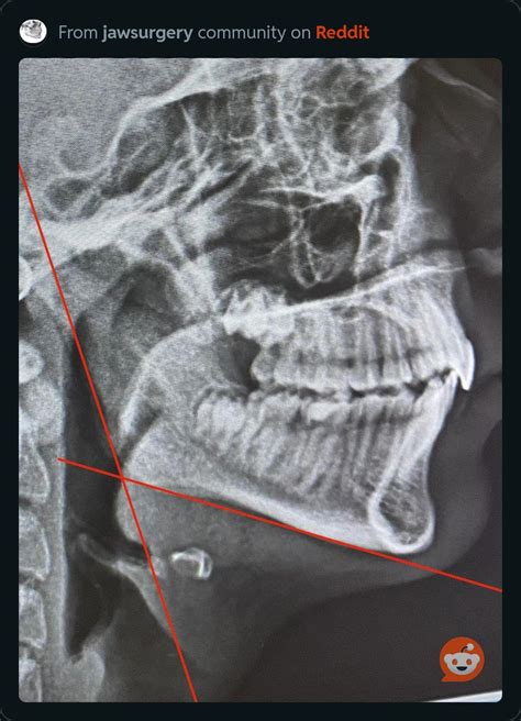Is My Chin Recessed Rorthotropics