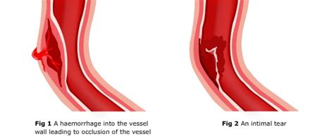 Carotid And Vertebral Artery Dissection Rcemlearning