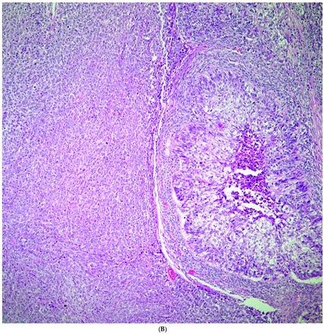 A Sarcomatoid Carcinoma Associated With Areas Of Conventional