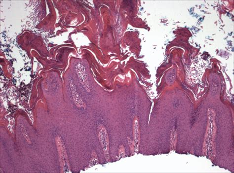 Verrucous Papules And Plaques In A Pediatric Patient—quiz Case