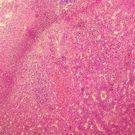 Microscopic View Of Suppurative Inflammation And Abscess Formation In Download Scientific