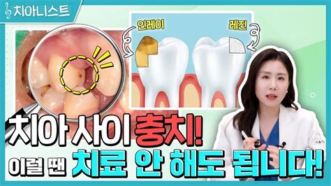 치아 사이 숨어있는 충치 인접면충치🦷 이럴 땐 치료하지 마세요 Youtube