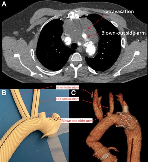 Colonic Stent Assisted Endoluminal Embolization In The Aortic Arch