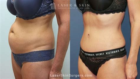 Body Contouring Treatments New York Ny Laser Center