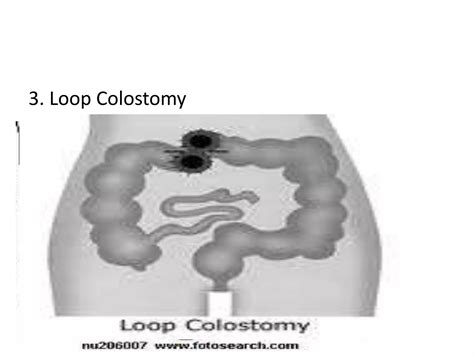 Colostomy Pptx