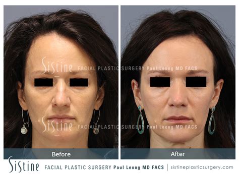 Rhinoplasty Before And After 24 Sistine Facial Plastic Surgery