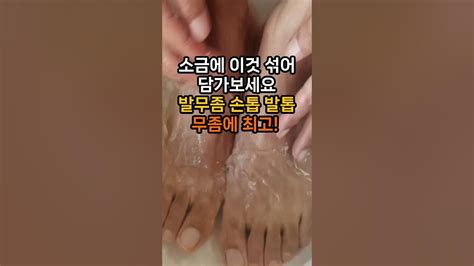 소금에 이것 넣어 발을 담가보세요 발톱무좀에 최고 발 무좀 발톱무좀에좋은식품 무좀족욕 무좀치료 발톱무좀 발무좀 무좀 소금활용법 Youtube