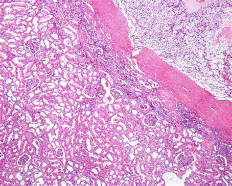 Clear Cell Renal Carcinoma Light Micrograph Stock Image C0560779