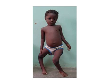 Acquired Bone Deformities Ppt