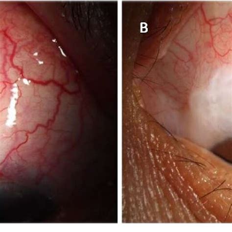 Bleb Morphology After Trabeculectomy A Bleb In Group 1 B Bleb In