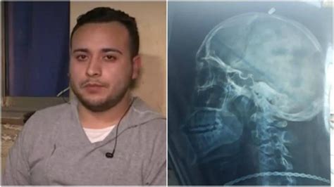 Pasa Ocho Meses Con Una Bala En La Cabeza Por Una Negligencia Médica