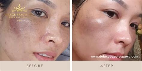 Dark Spot Treatment—deluxe Beaute Spa Bellevue Deluxe Beaute Spa